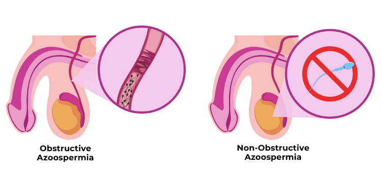 Azoospermia: Causes, Symptoms, Diagnosis, and Treatment